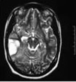 Case Report: Application of Frameless Stereotaxy to Brain Tumor Surgery ...