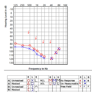 Profound Sensorineural Hearing Loss Audiogram